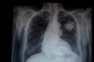 Medtronic's Micra | The world's smallest pacemaker